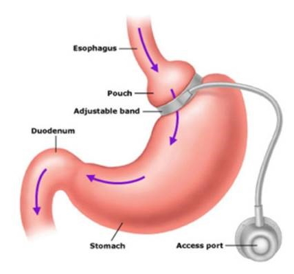 Gastric Lap Band Surgery Sydney | SIOS Specialised Surgeons
